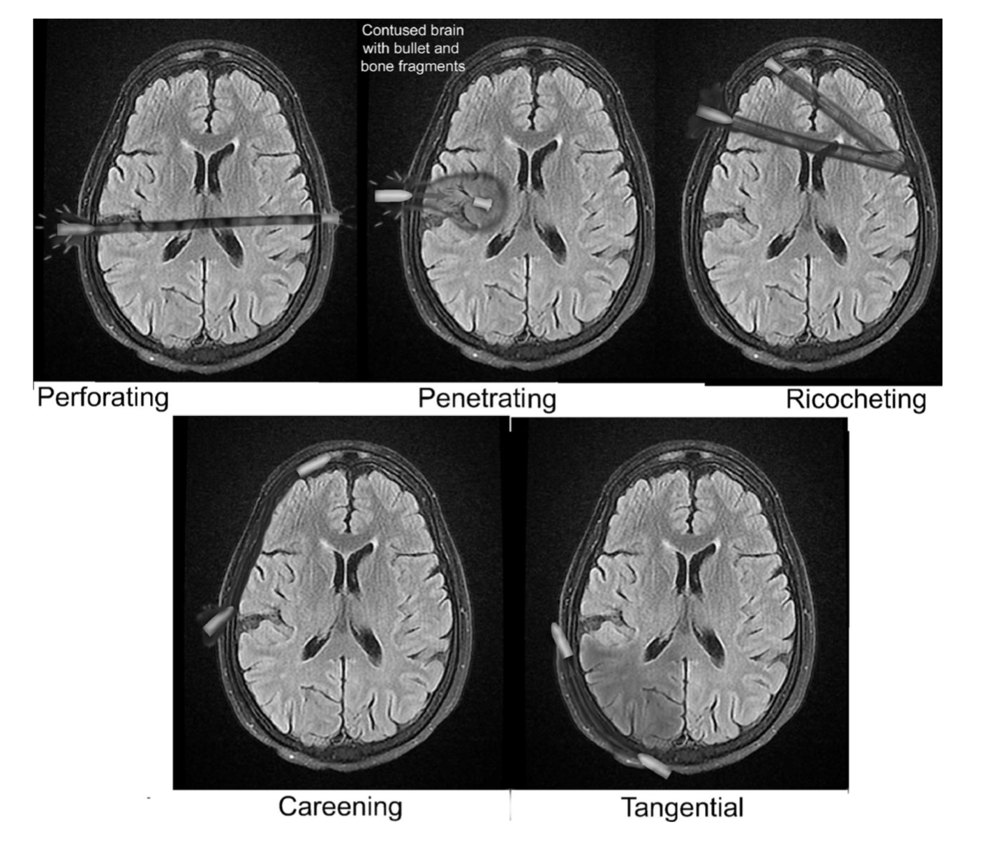 Neurosurgery Bullet Review: Gunshot Penetrating Brain Injury – NIT ...