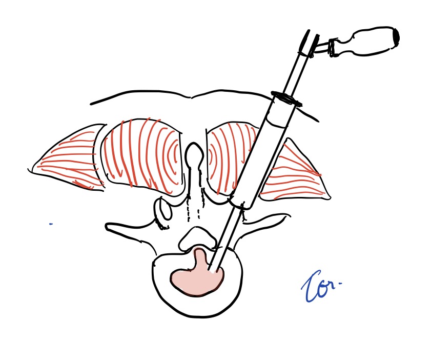 endodisc-drawing – NIT Neurosurgery