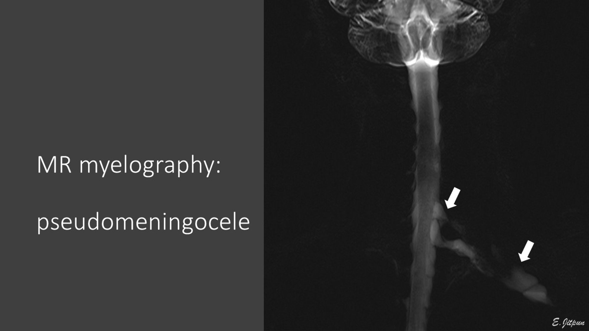 Brachial Plexus Injury – NIT Neurosurgery