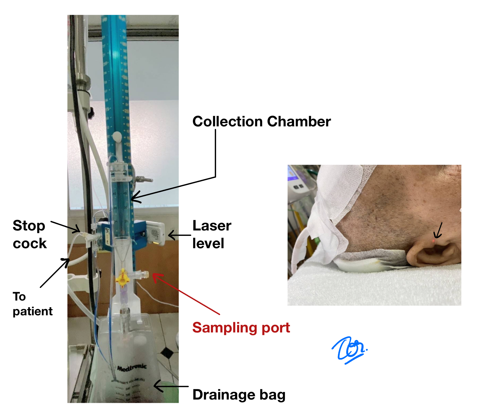 การดูแล ventriculostomy (EVD) เบื้องต้นสำหรับ Non-neurosurgeon ...